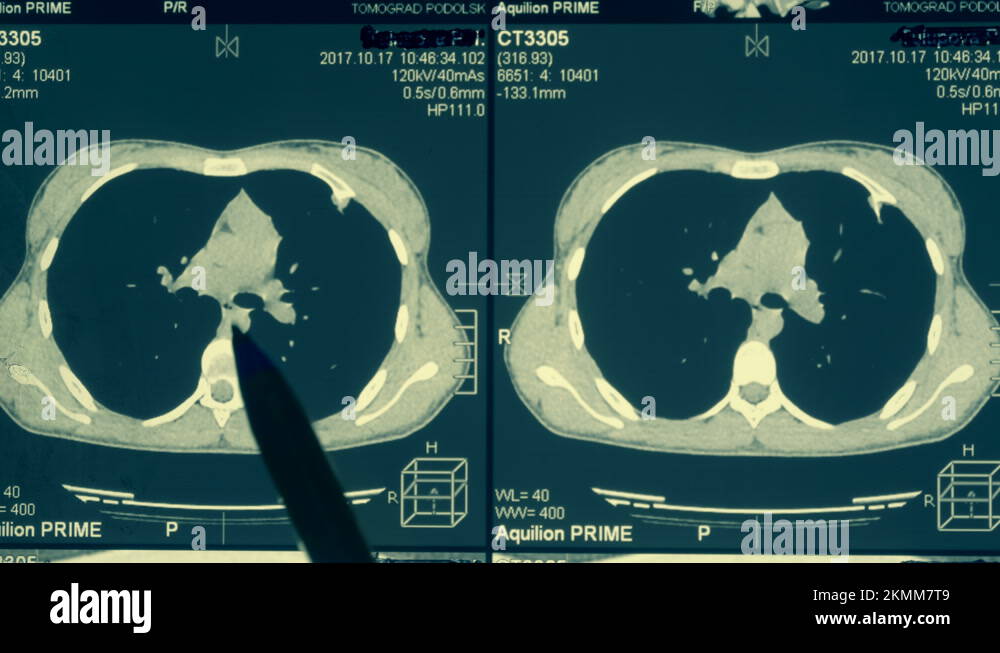 Magnetic resonance imaging (MRI) of the chest and lung Stock Video ...
