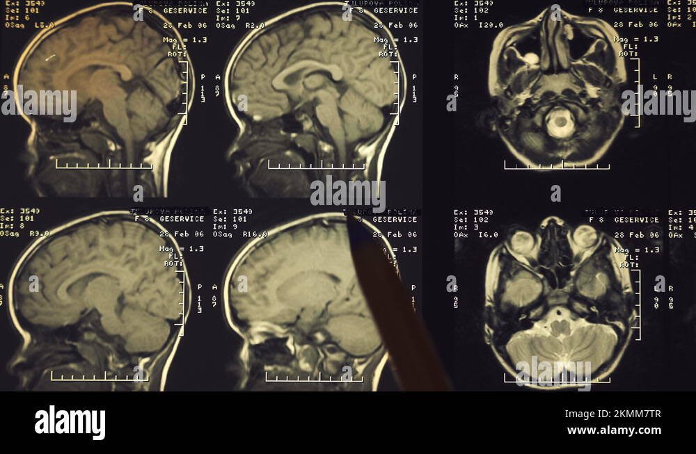 Brain mri area Stock Videos & Footage - HD and 4K Video Clips - Alamy