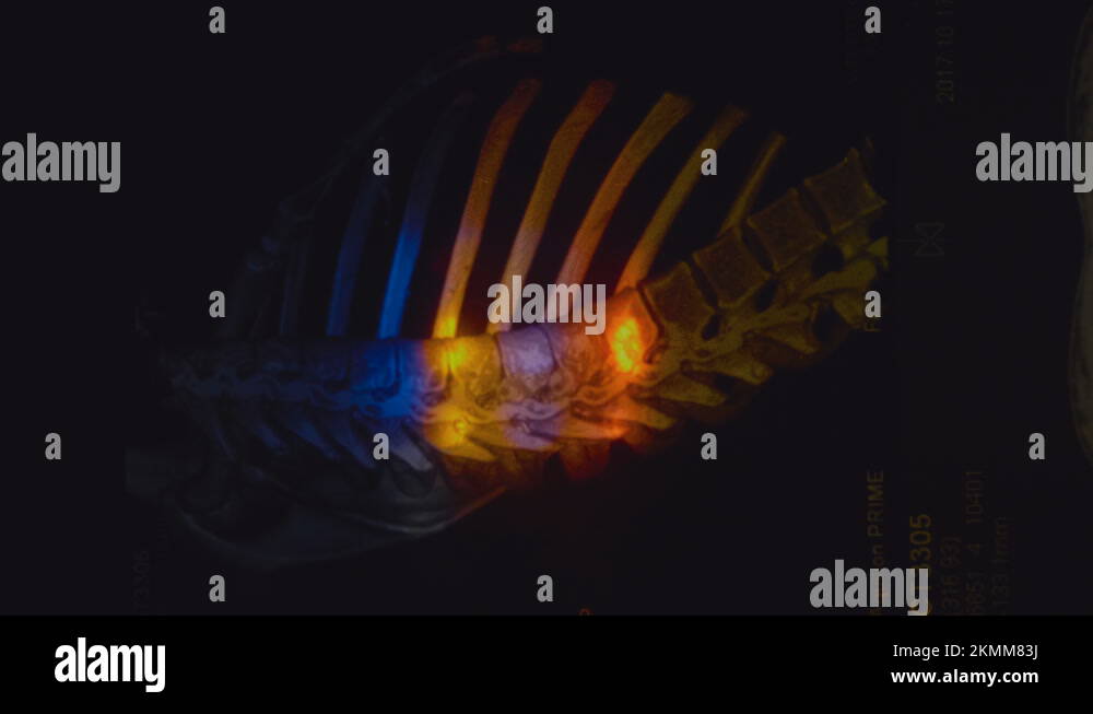 Magnetic resonance imaging (MRI) of the human chest with ribs and spine ...