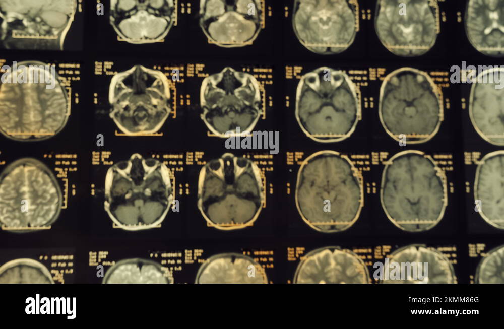 Magnetic resonance imaging (mri) of the human brain. Closeup. Macro ...