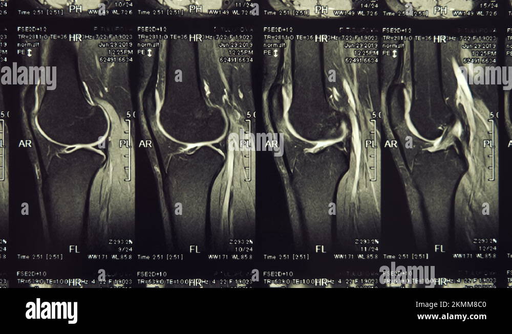 Meniscus mri Stock Videos & Footage - HD and 4K Video Clips - Alamy