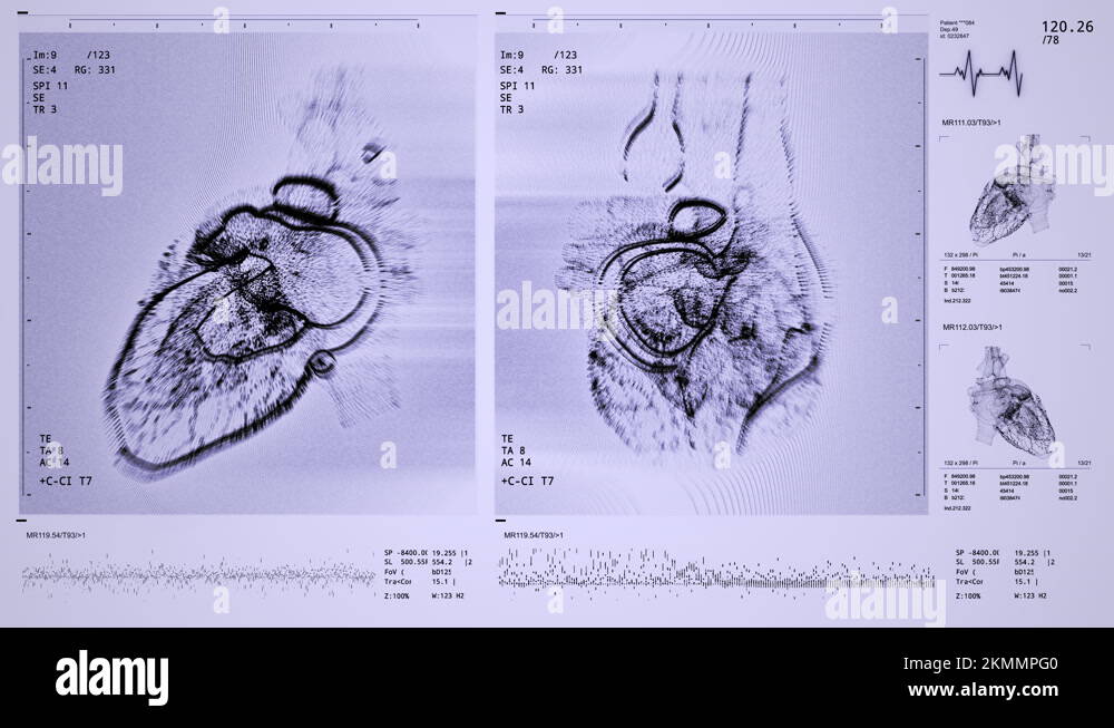 Heart Scan Front Side View Animation Digital Artifacts Dynamic Glitches Stock Video Footage