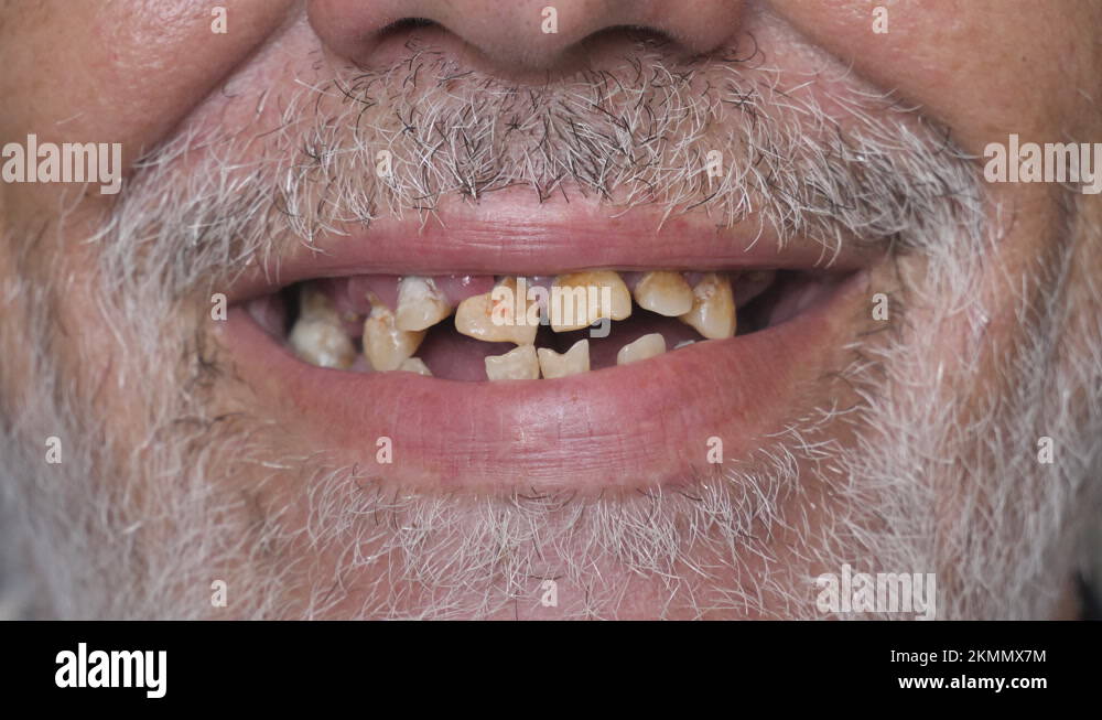 Bad teeth Stock Videos & Footage - HD and 4K Video Clips - Alamy