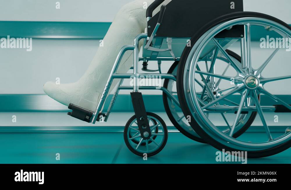 Patient broken leg in plaster Stock Videos & Footage - HD and 4K Video ...