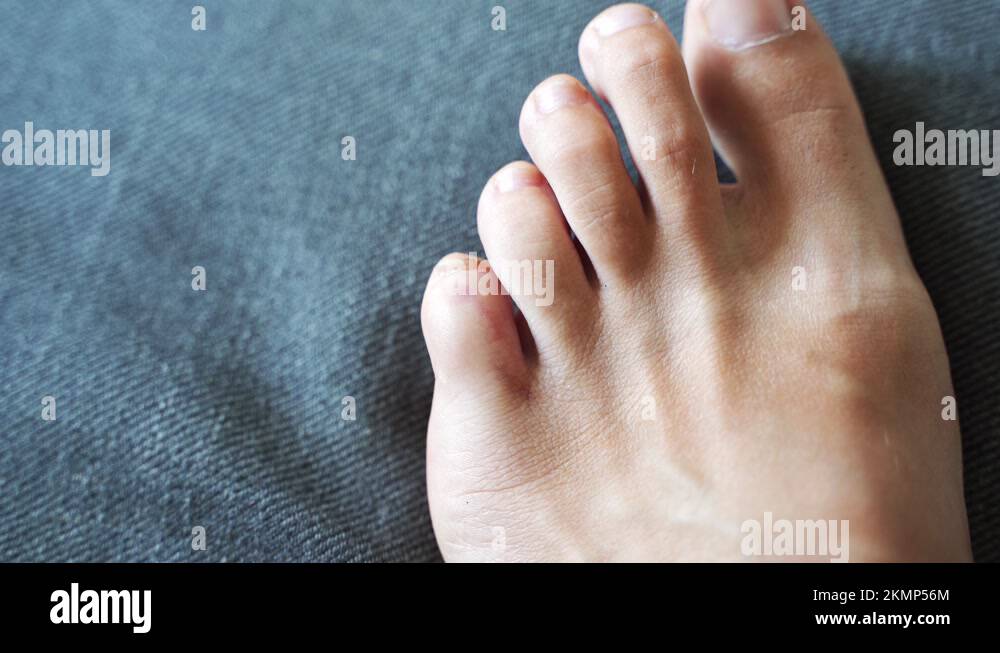 Foot little finger injury. Little toe pain and bruise after home ...