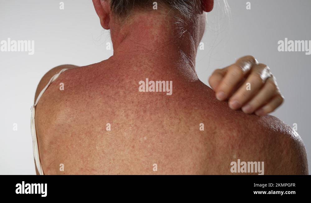 Woman scratching dry flaky skin on hand with psoriasis, eczema and ...