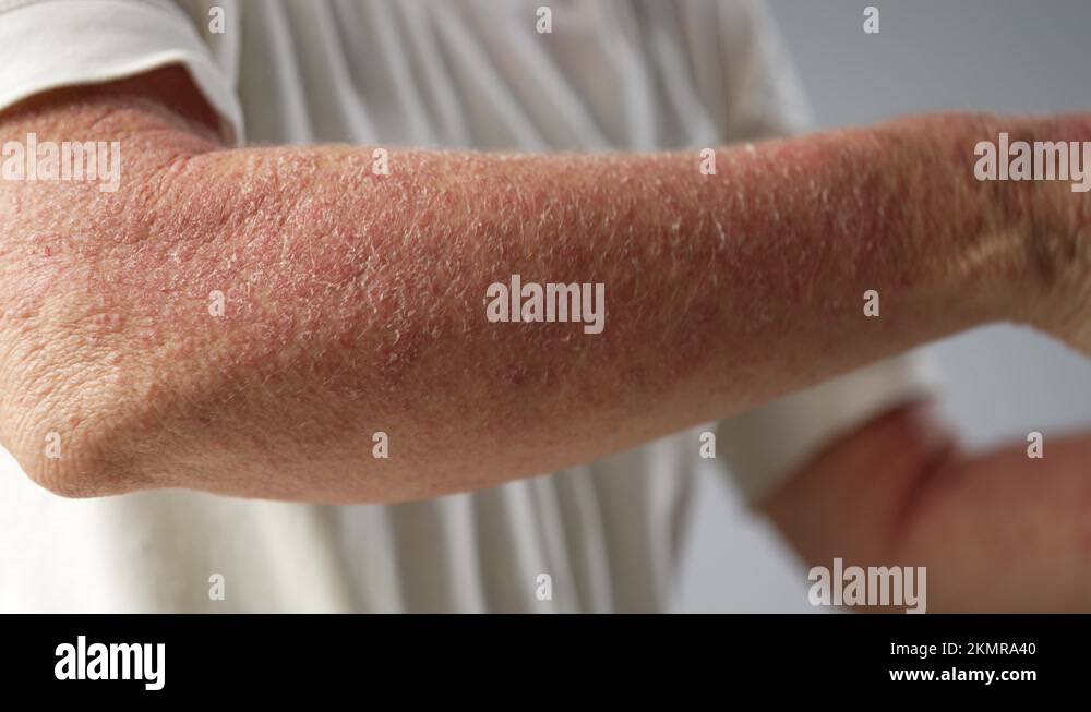 Extreme Closeup Of Woman Showing Dry Scaly Skin Rash Hives On Her Arm Shown On Stock Video