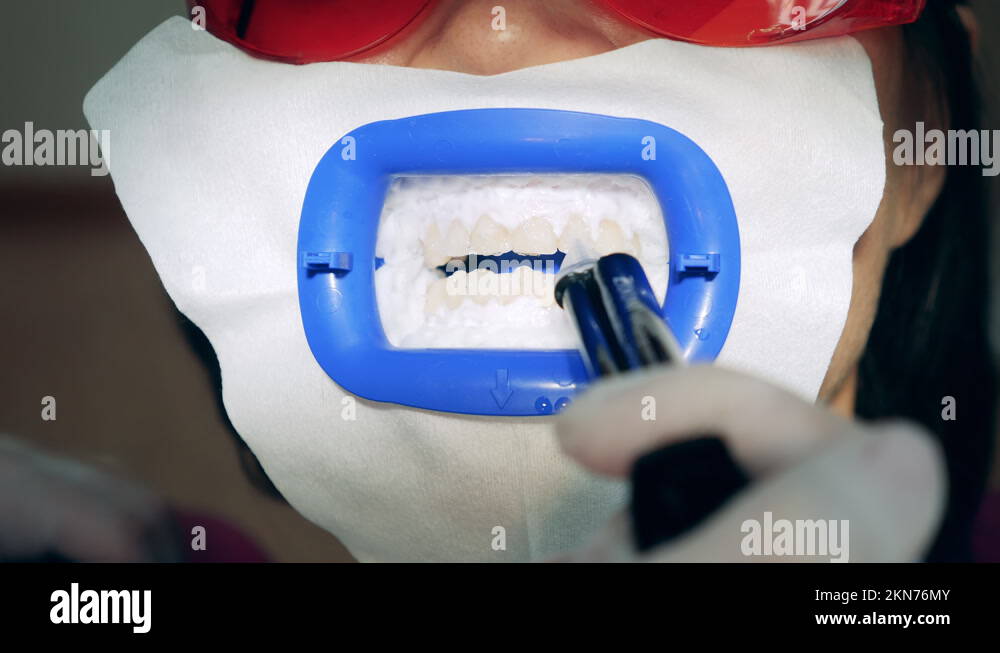 Bleaching procedure Stock Videos & Footage - HD and 4K Video Clips - Alamy