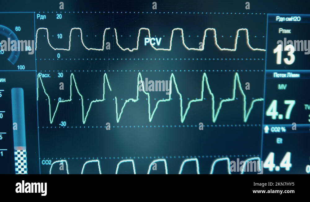 Screen of a medical monitor displaying diagrams of vital signs Stock ...