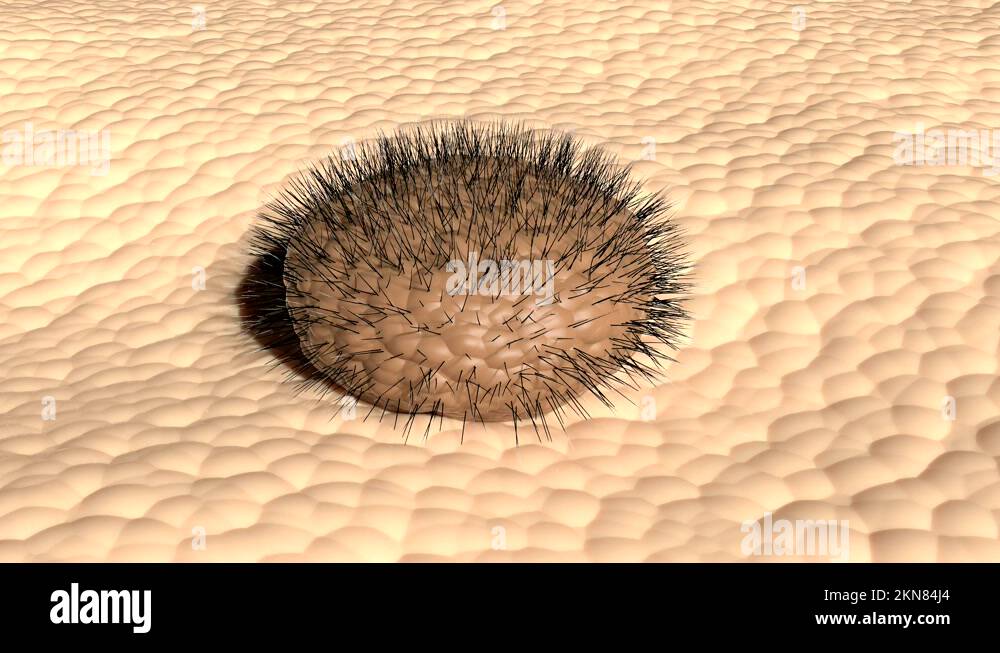 Melanoma cancer Stock Videos & Footage - HD and 4K Video Clips - Alamy