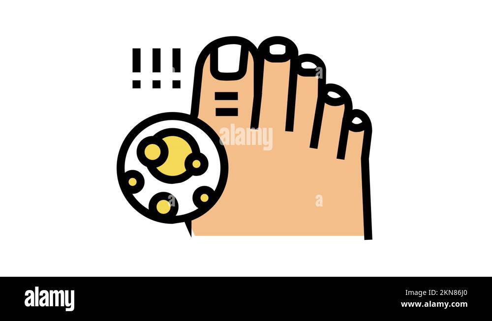 Uric acid crystals Stock Videos & Footage - HD and 4K Video Clips - Alamy