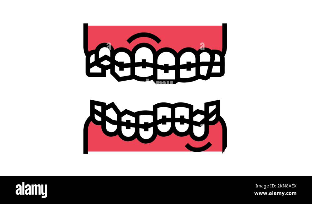 correction tooth braces color icon animation Stock Video Footage - Alamy