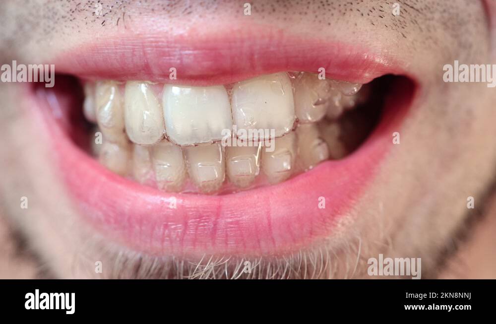 Transparent bite Stock Videos & Footage - HD and 4K Video Clips - Alamy