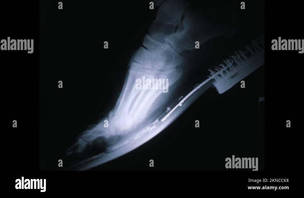 X ray foot shoe Stock Videos & Footage - HD and 4K Video Clips - Alamy