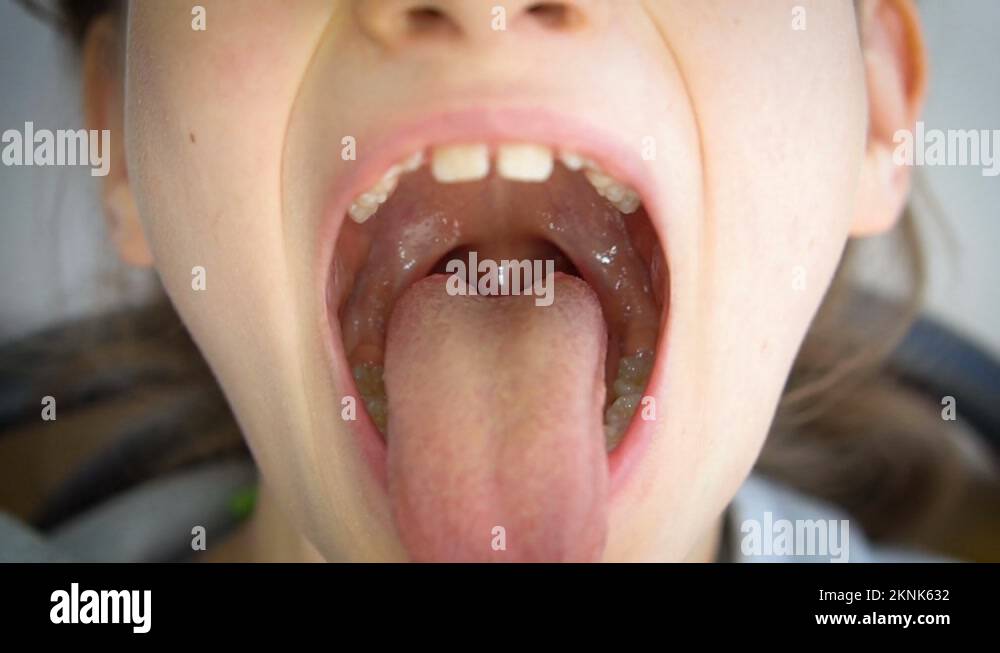 Wide Open Mouth With A Tongue Stuck Out View Of The Uvula And The Soft Palate Stock Video