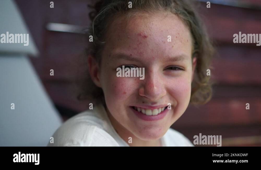 Close up portrait of a smiling bright teenage girl with teenage rashes ...