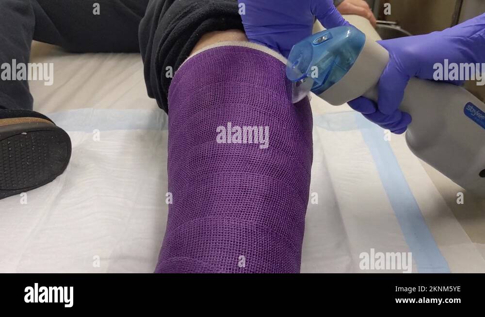 A gloved orthopedic nurse cuts through the outside of a left leg cast ...