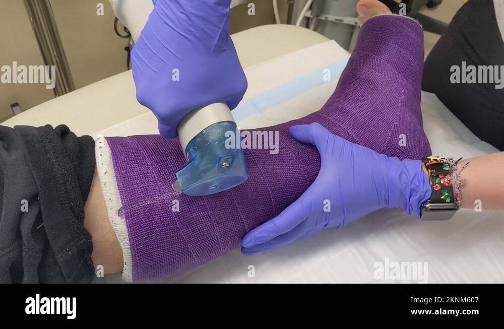 Leg cast removal Stock Videos & Footage - HD and 4K Video Clips - Alamy
