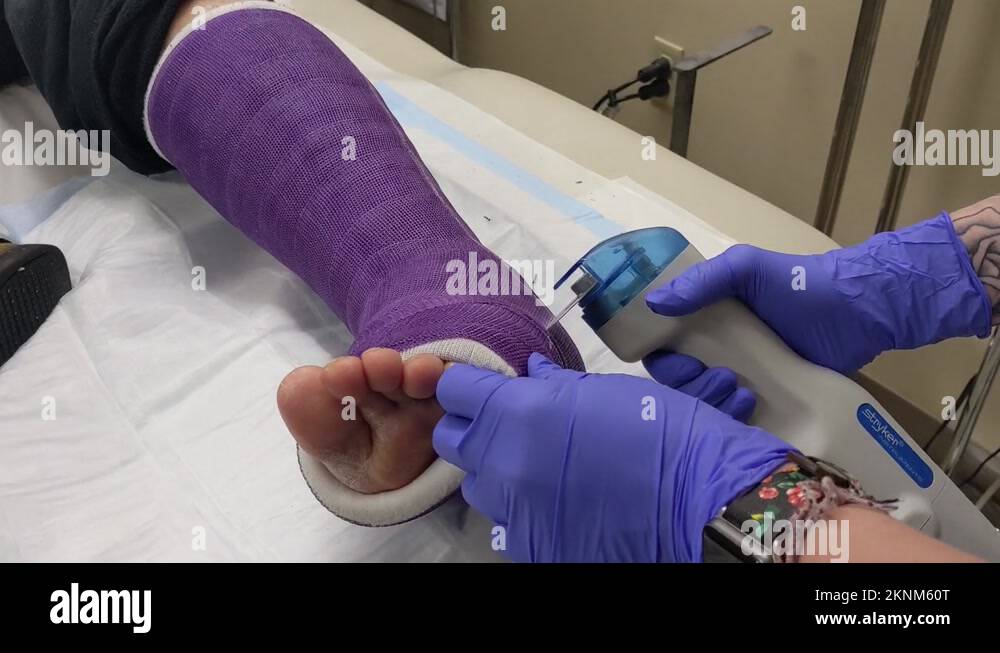 A gloved orthopedic nurse cuts through the outside of a left leg cast ...