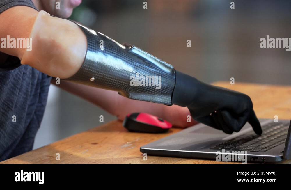 A man with amputated stump hands types at laptop using new bionic hand ...
