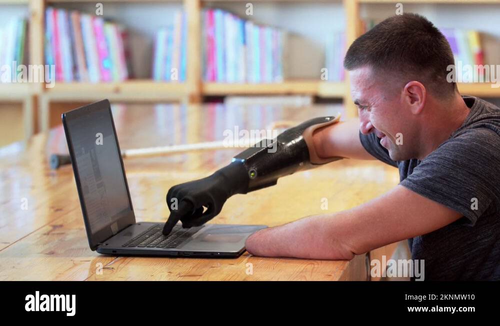 A man with amputated stump hands types at laptop using new bionic hand ...