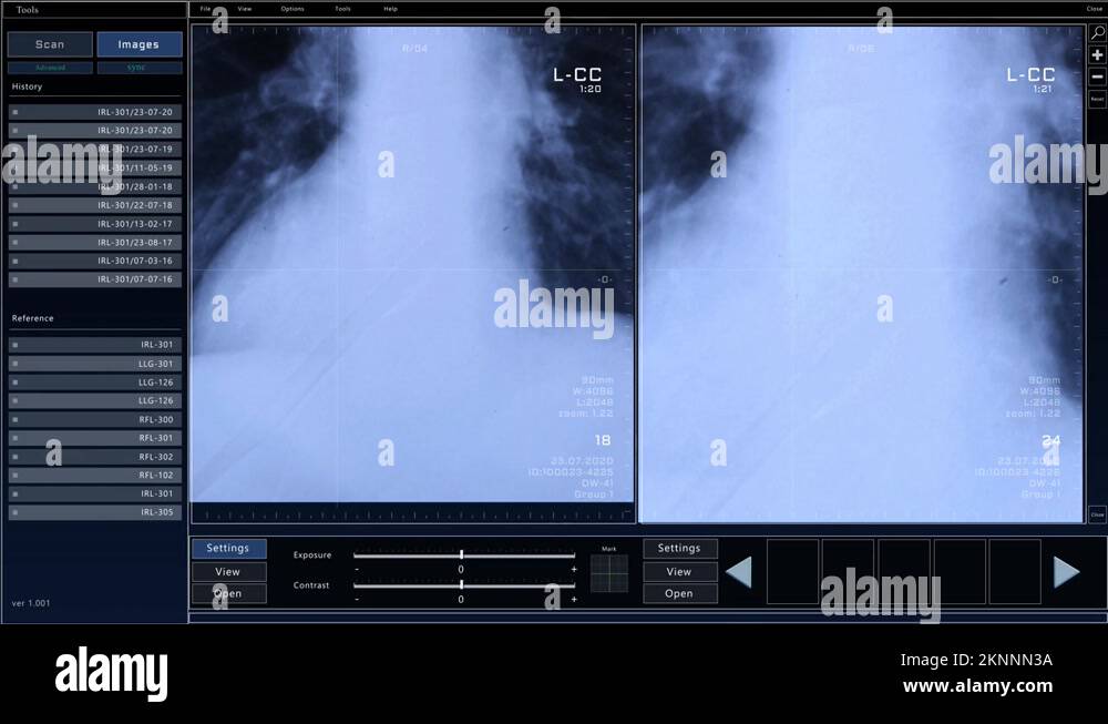 Chest xray cancer Stock Videos & Footage - HD and 4K Video Clips - Alamy