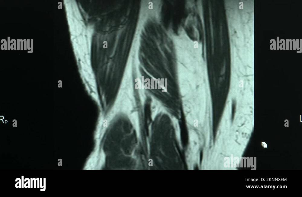 MRI scan screen animation. Computed medical tomography MRI Stock Video ...
