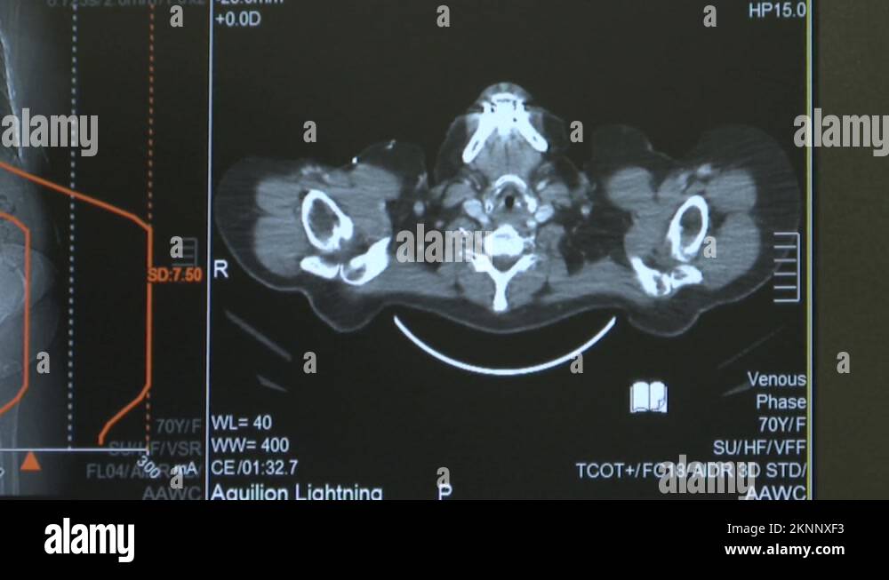 MRI scan screen animation. Computed medical tomography MRI Stock Video ...
