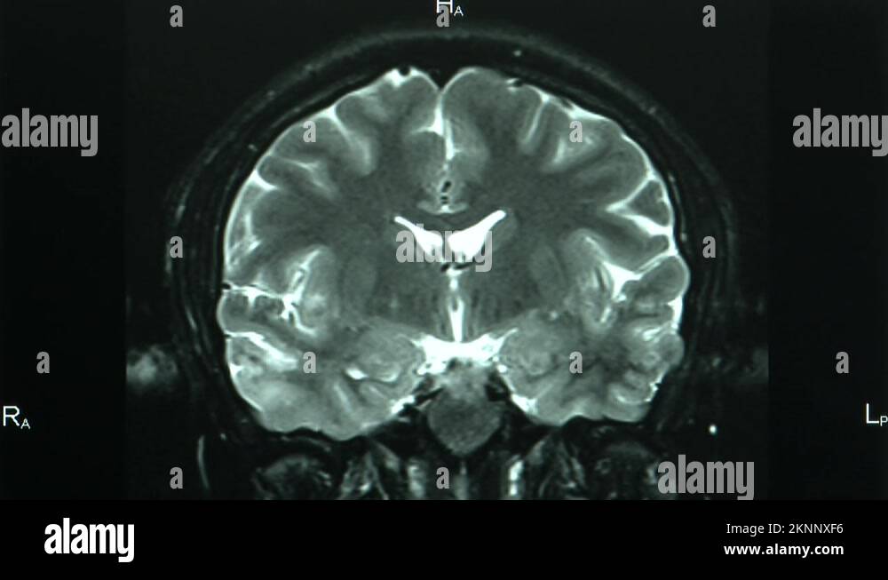 MRI scan screen animation. Computed medical tomography MRI Stock Video ...