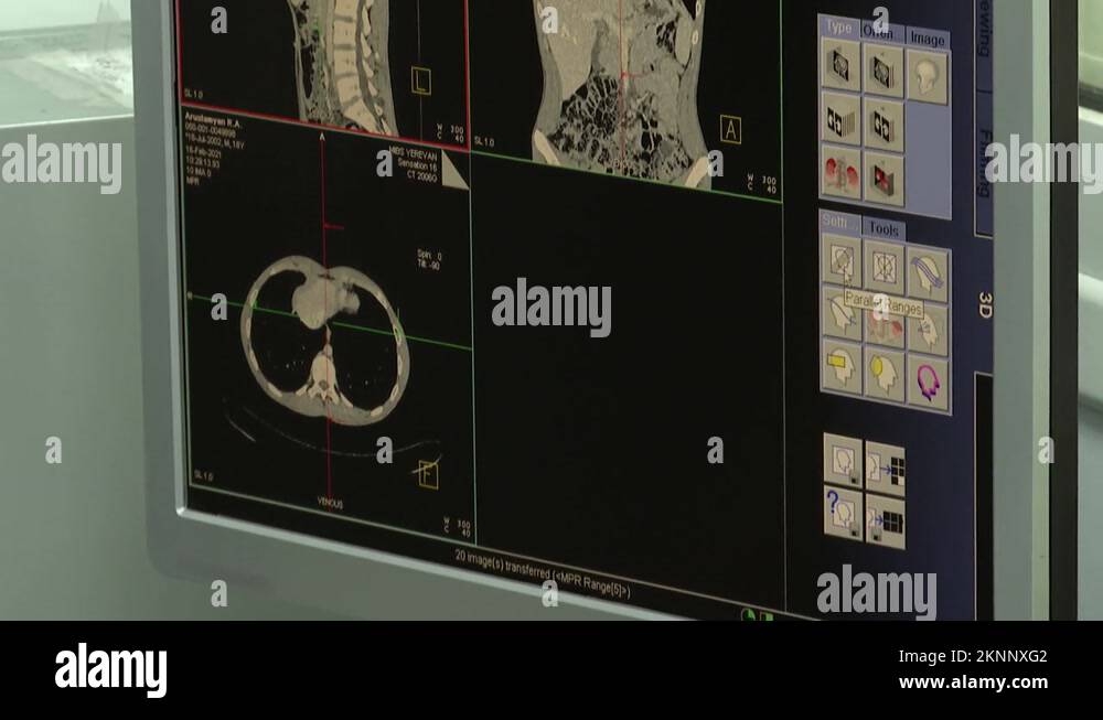 MRI scan screen animation. Computed medical tomography MRI Stock Video ...