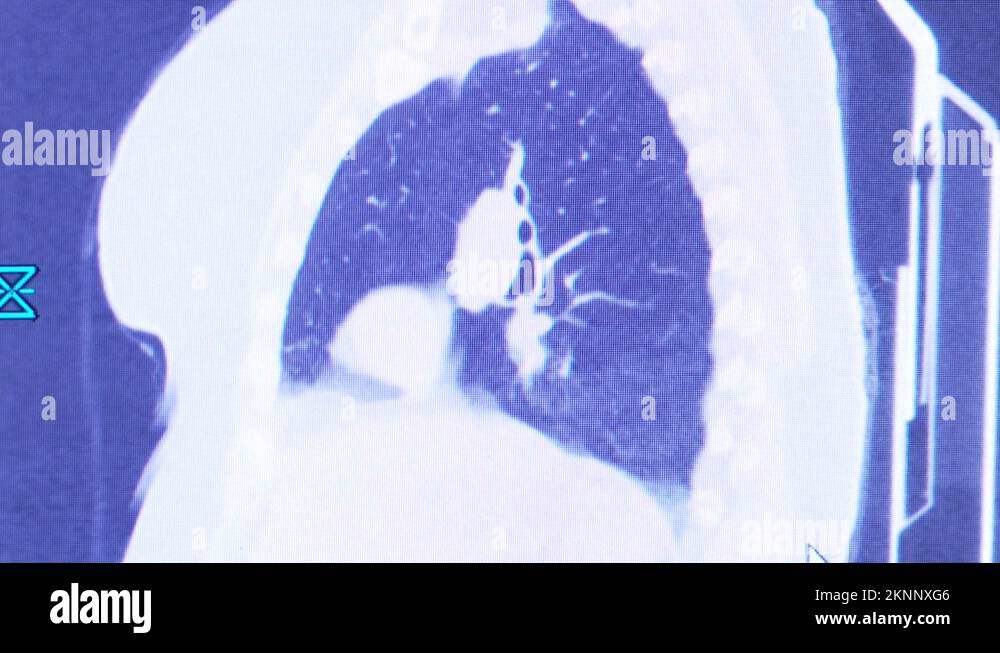 MRI scan screen animation. Computed medical tomography MRI Stock Video ...