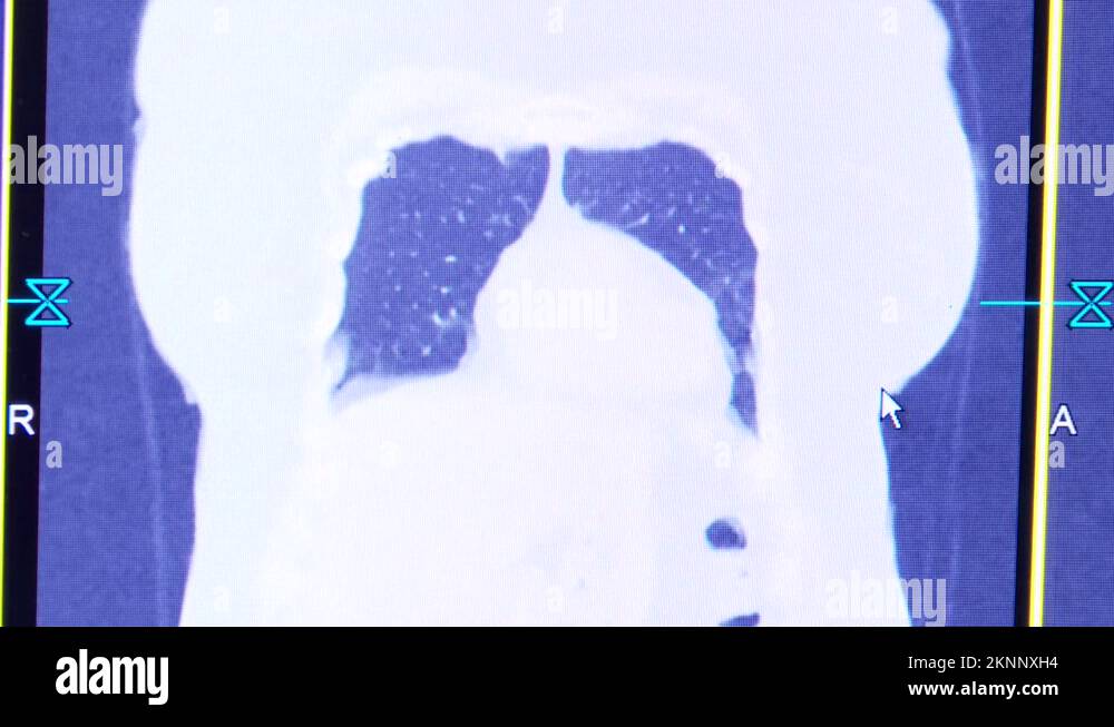 MRI scan screen animation. Computed medical tomography MRI Stock Video ...