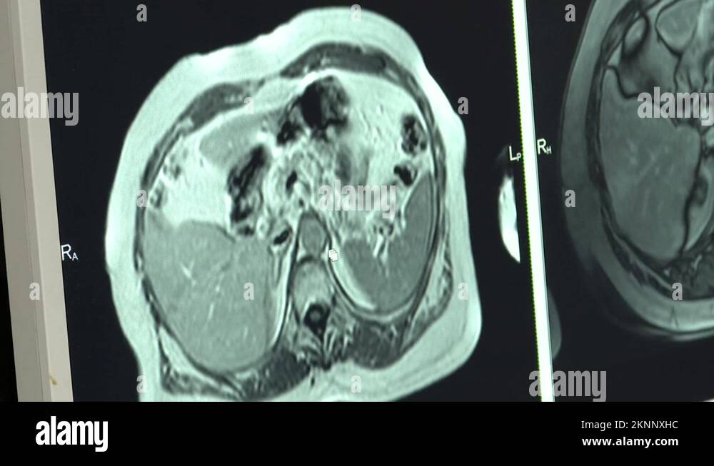 MRI scan screen animation. Computed medical tomography MRI Stock Video ...