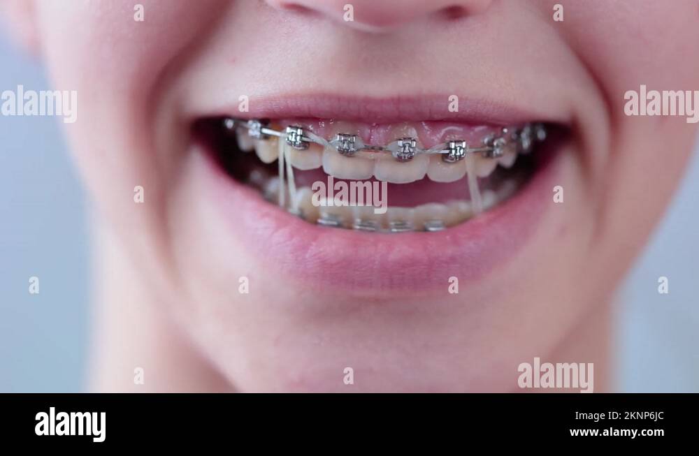 Orthodontic braces on teeth Stock Videos & Footage - HD and 4K Video ...