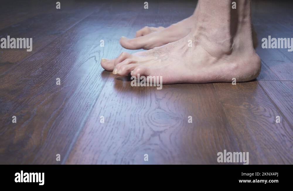 Feet deformities Stock Videos & Footage - HD and 4K Video Clips - Alamy