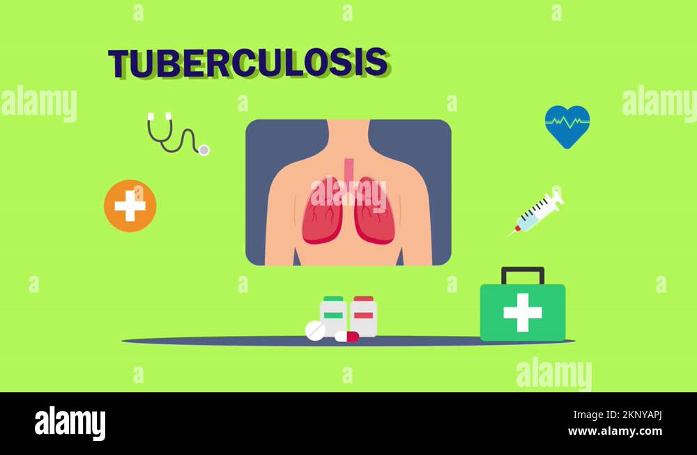 Tuberculosis disease Stock Videos & Footage - HD and 4K Video Clips - Alamy