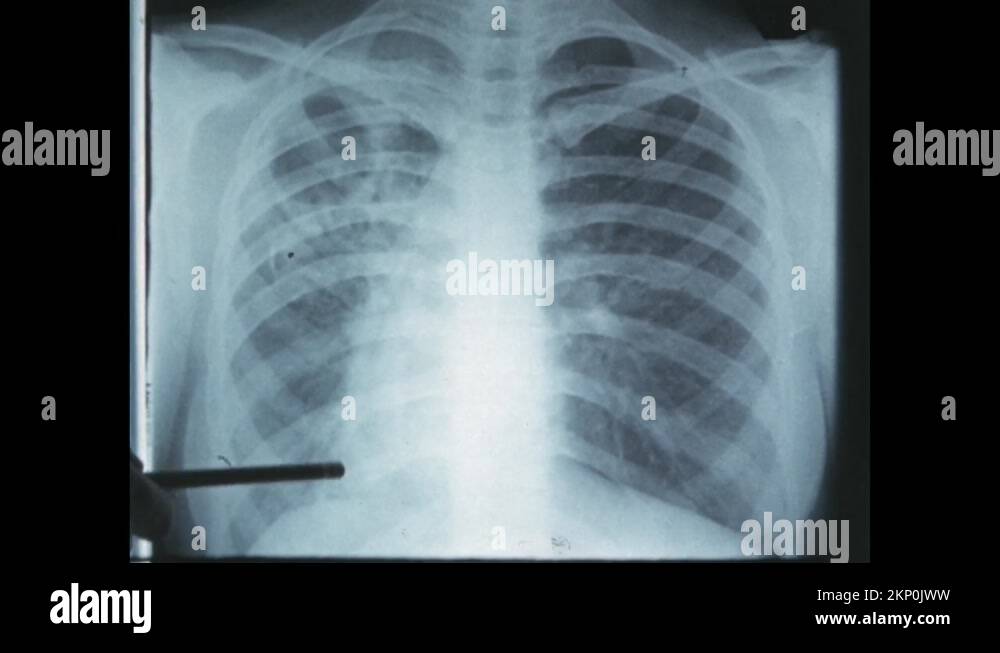 Chest x rays Stock Videos & Footage - HD and 4K Video Clips - Alamy