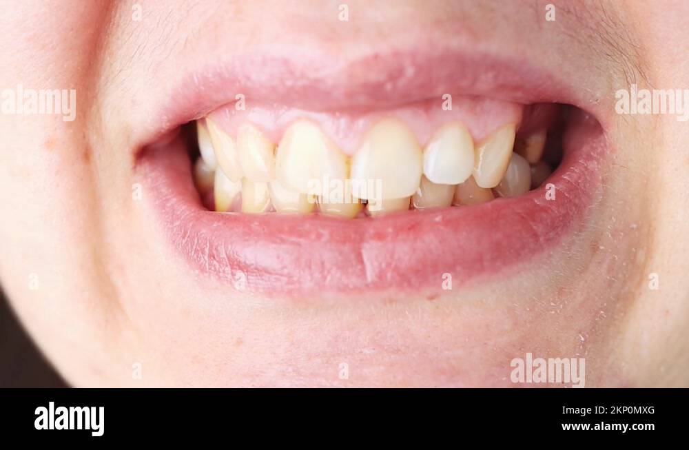 Problematic female skin with acne and black hair above the upper lip ...