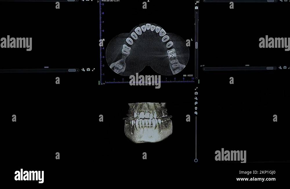 3d model of an x-ray image of a human jaw. Computer program for dental ...