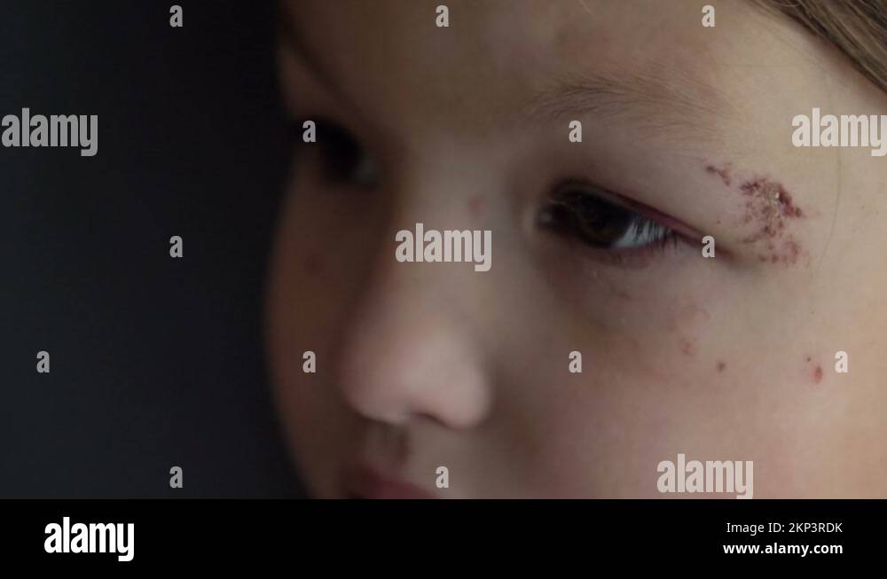 Close-up of a painful wound near the eye of a 6-7 year old girl Stock ...