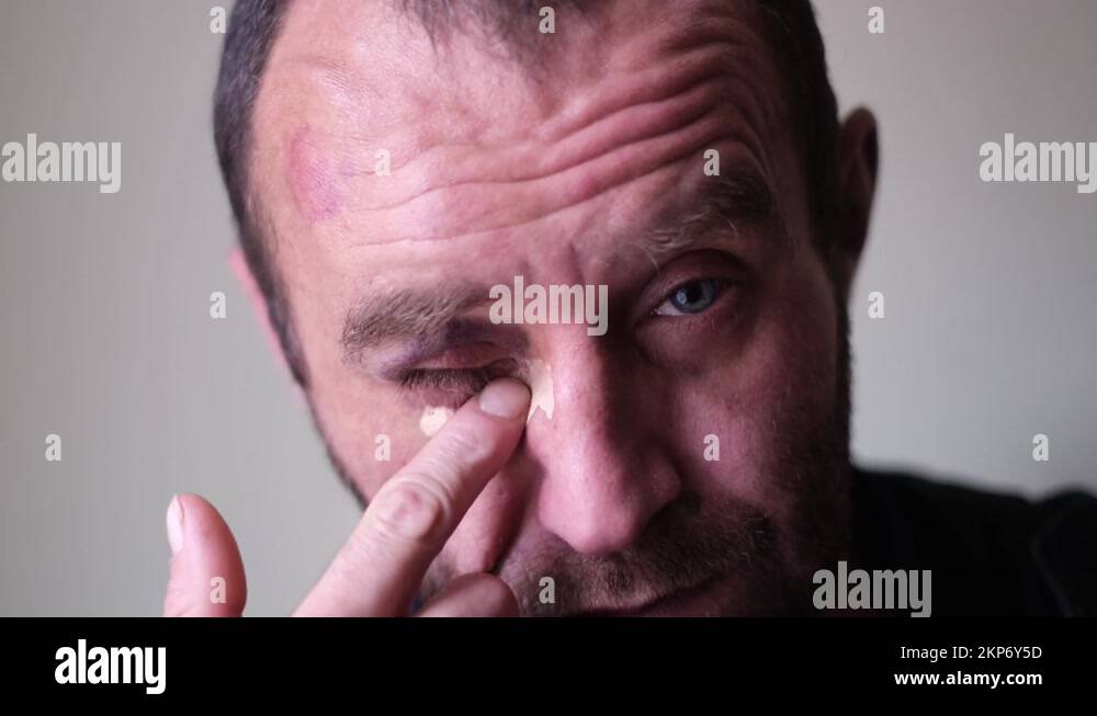 The man has a bruise under the eye, smeared with hematoma cream on his ...