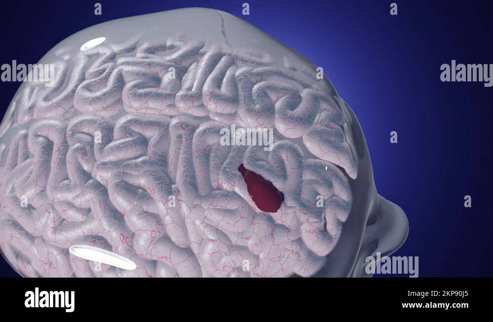 Skull with Brain Hemorrhage - BlueBG Stock Video Footage - Alamy