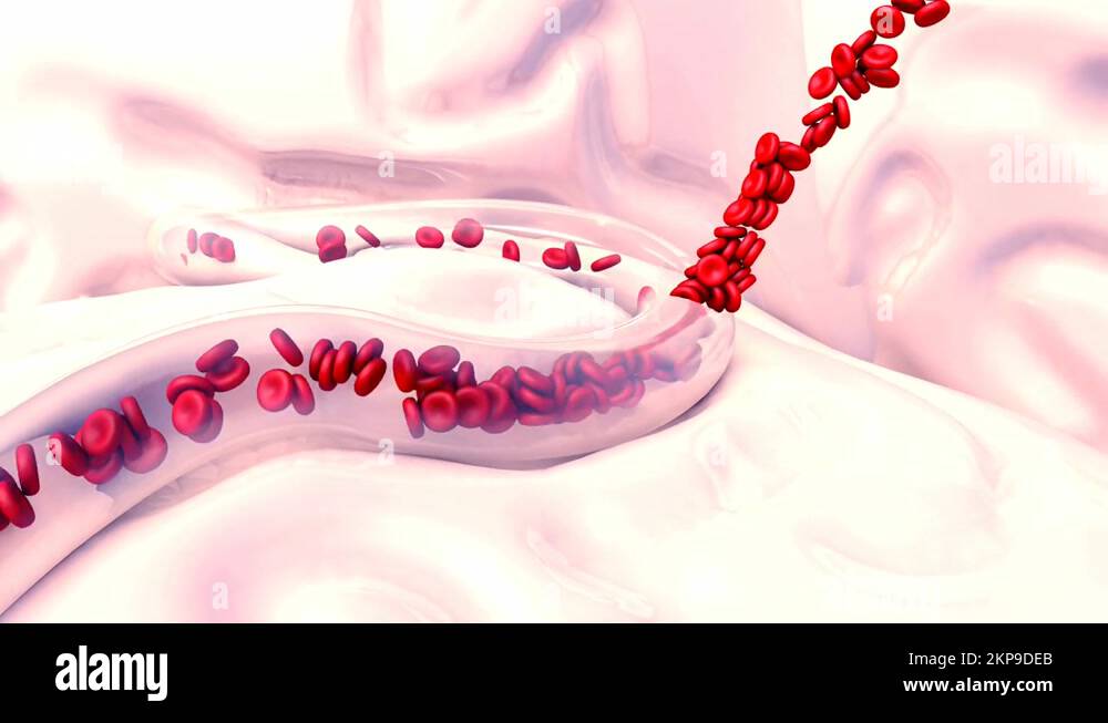 Bleeding blood vessel, animation Stock Video Footage - Alamy Bleeding blood vessel, animation Stock Video Footage - Alamy