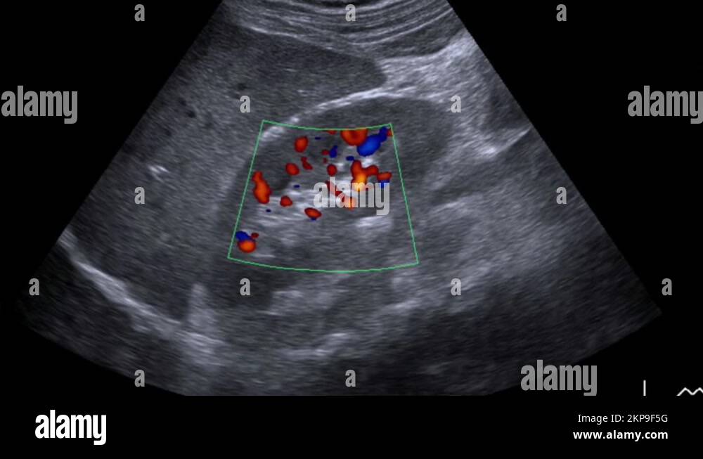 Kidney ultrasound Stock Videos & Footage - HD and 4K Video Clips - Alamy