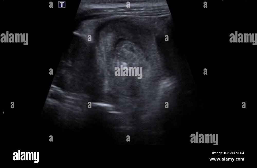 Intussusception in baby's intestine, ultrasound Stock Video Footage - Alamy