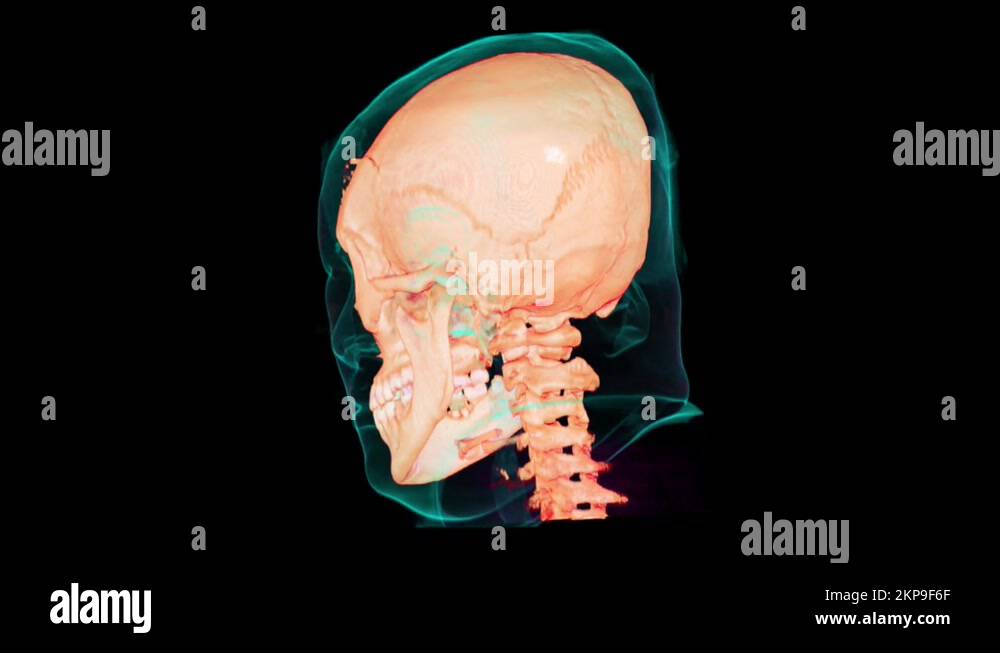 Ct scan head fracture Stock Videos & Footage - HD and 4K Video Clips ...