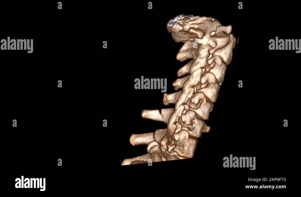 Neck vertebra dislocation, 3D CT scan Stock Video Footage - Alamy