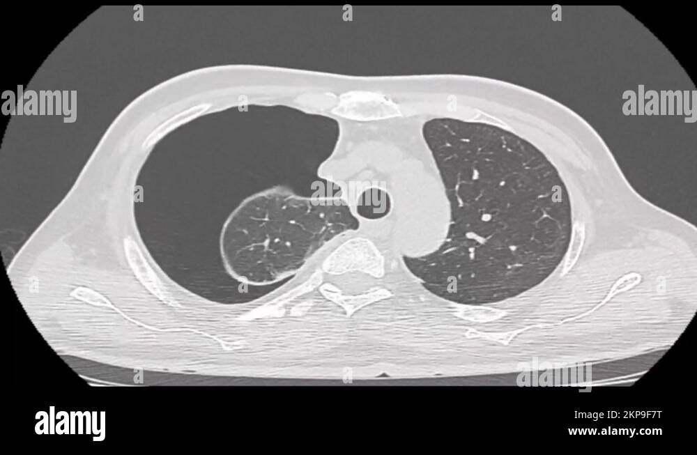 Pneumothorax, CT scan Stock Video Footage - Alamy