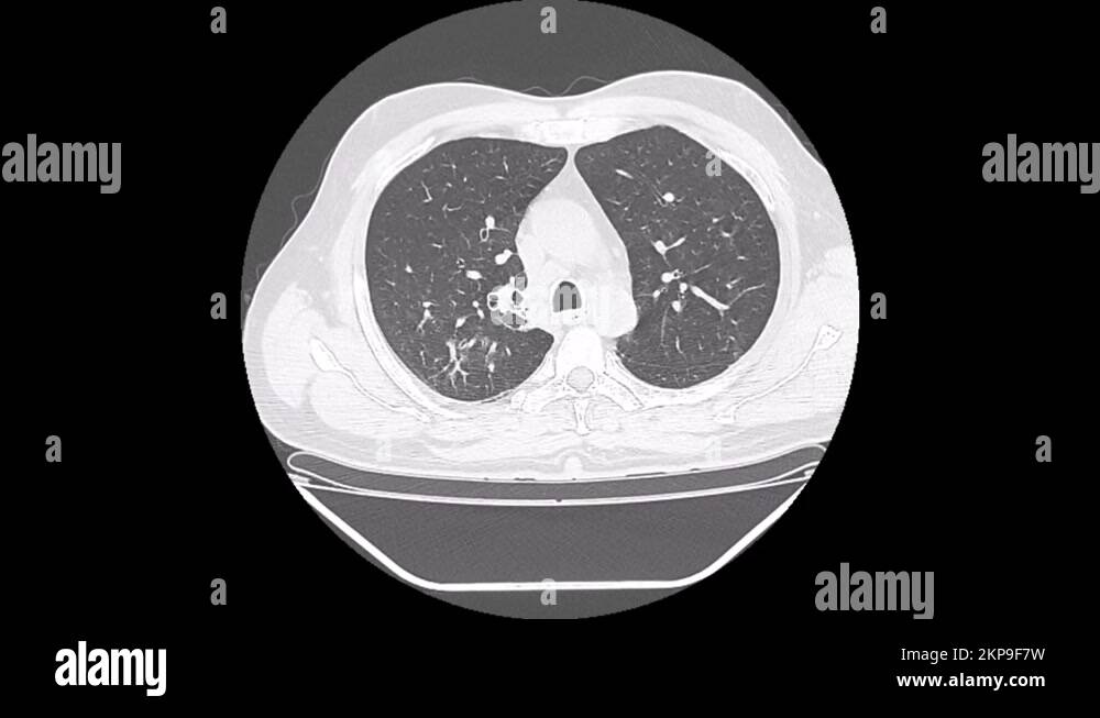 Ct scan lung cancer Stock Videos & Footage - HD and 4K Video Clips - Alamy