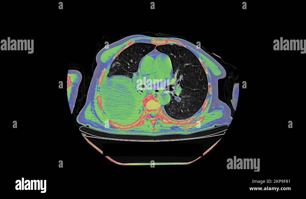 Pleural Effusion On Ct Scan